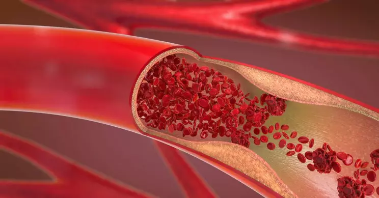 Muchas cirugías cardíacas para arterias bloqueadas son injustificadas, encuentra un nuevo estudio federal