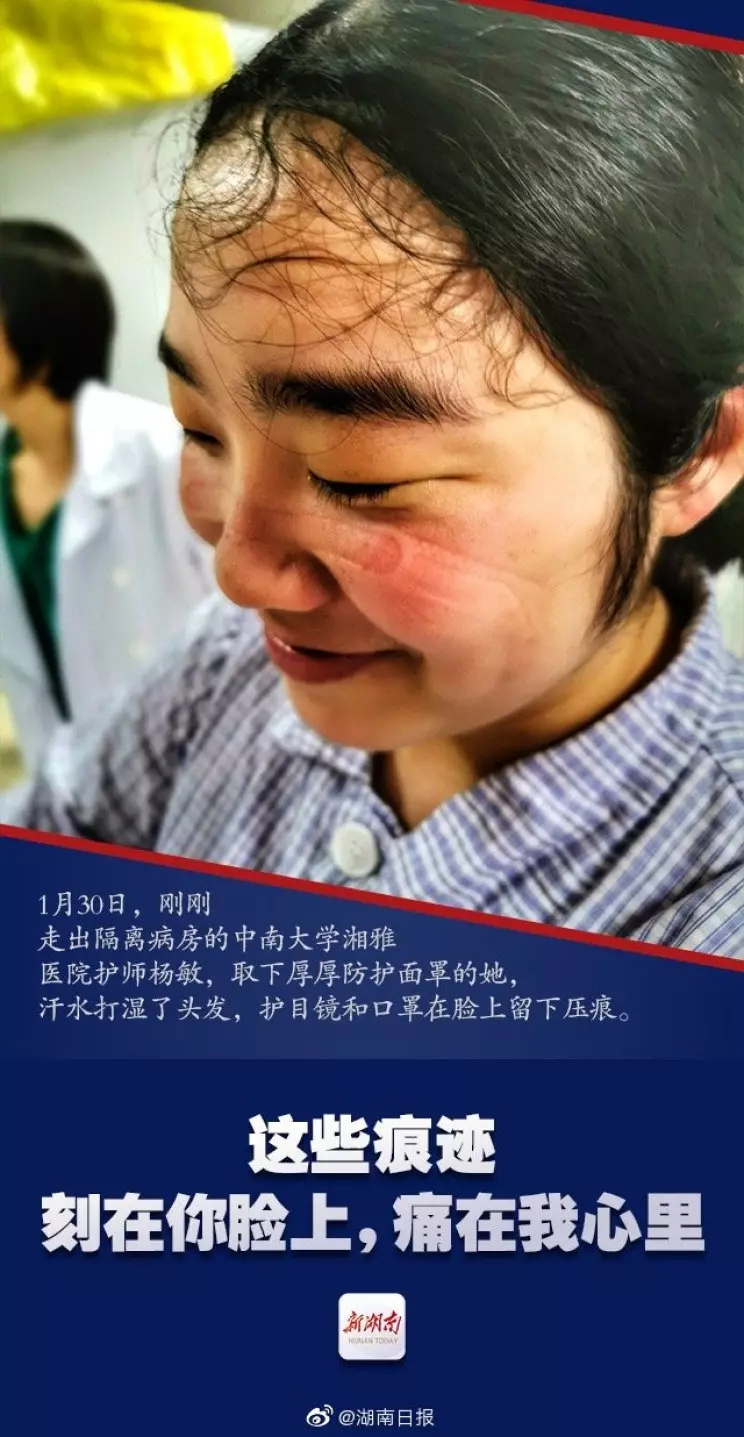 Ridetantaj Vizaĝoj de Medicina Kunlaborantaro en Wuhan Post Traktado de Koronavirusaj Pacientoj dum Horoj