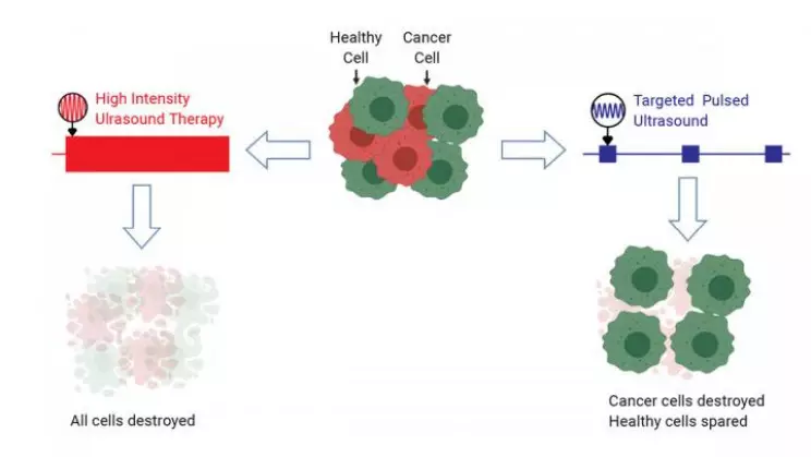 Ультразвук может избирательно уничтожать раковые клетки, считают исследователи