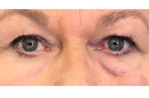 weird- second-skin- erases-wrinkles-wounds-eye-670