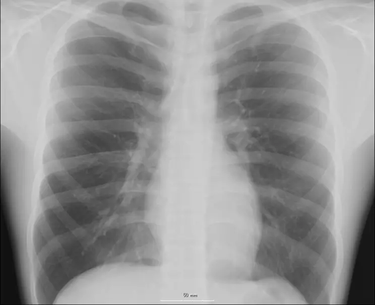 CT-Scan na X-ray na-egosipụta mmebi n'akpa ume nke ndị ọrịa COVID-19