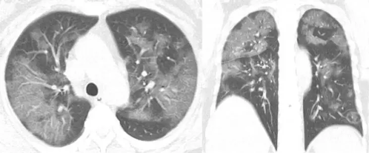 CT-Scan na X-ray na-egosipụta mmebi n'akpa ume nke ndị ọrịa COVID-19