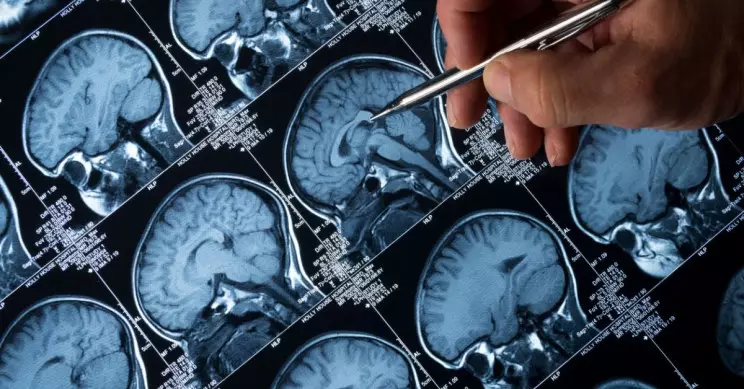 Поєднання ліків від шизофренії та радіаційного лікування допомагає знищити пухлину мозку