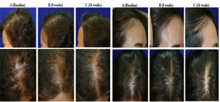 Posibleng Lunas ang Baldness sa Stem Cell Topical Solution