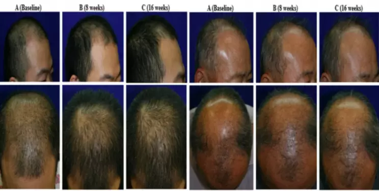 Posibleng Lunas ang Baldness sa Stem Cell Topical Solution