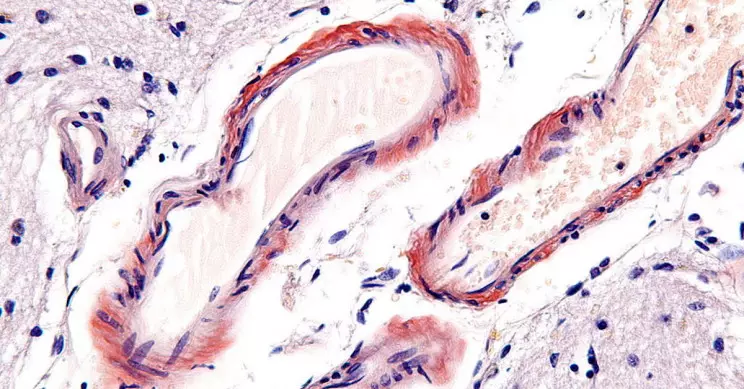 Microgravitația ISS este ideală pentru a studia proteina Alzheimer