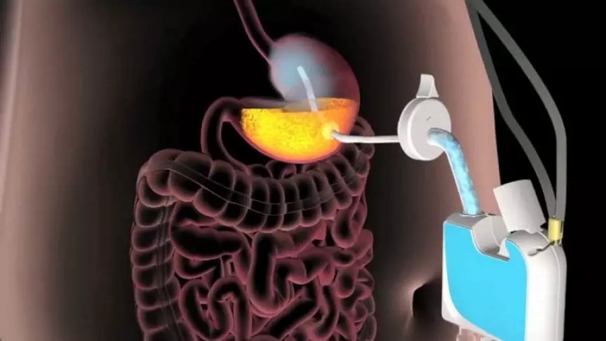 FDA je odobrila želučanu pumpu za mršavljenje koja odmah usisava hranu