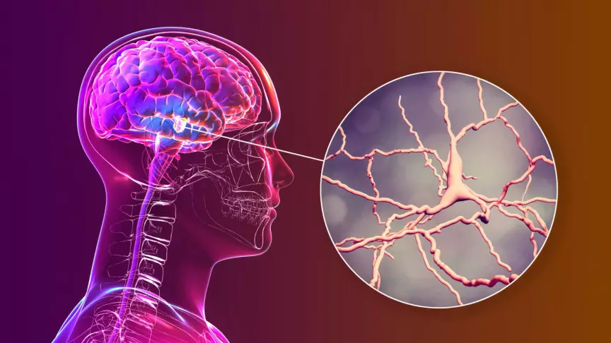 MRI eskaner indartsu berriek Parkinson gaixotasuna hobeto tratatzen lagun dezakete