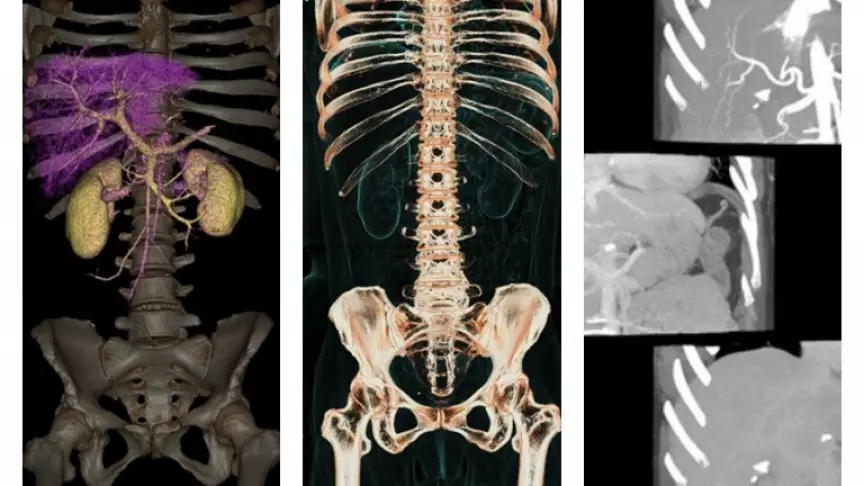 New CT Body Scanner Inobata Freakishly Yakakwirira Tsanangudzo 3D Mifananidzo