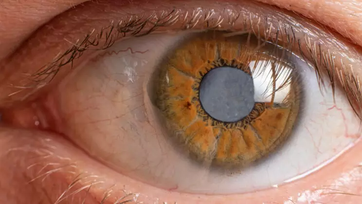 Un nou fàrmac podria resoldre el problema de les cataractes, sense cirurgia