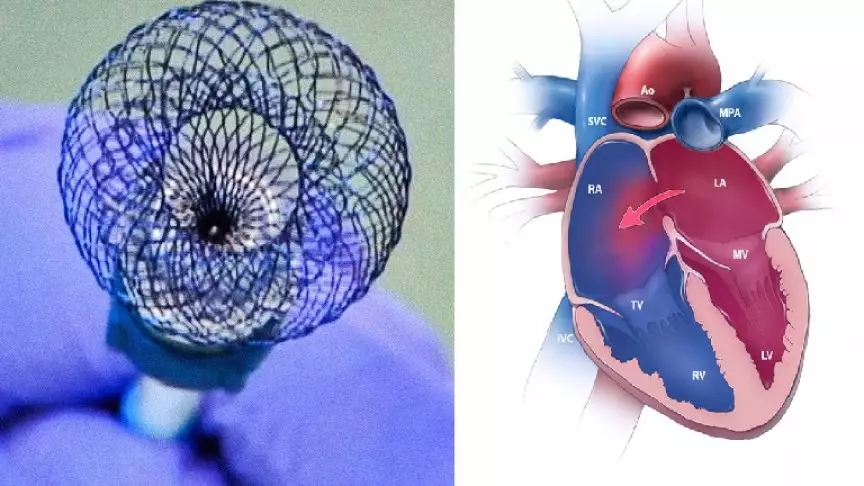 Una nova manera de curar els cors amb cirurgia no invasiva