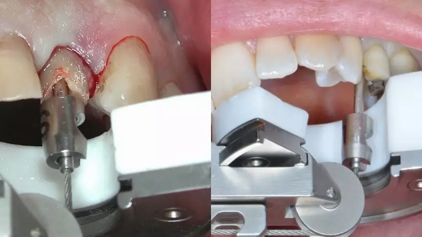Този иновативен инструмент може да бъде отговорът на безболезнените екстракции на зъби