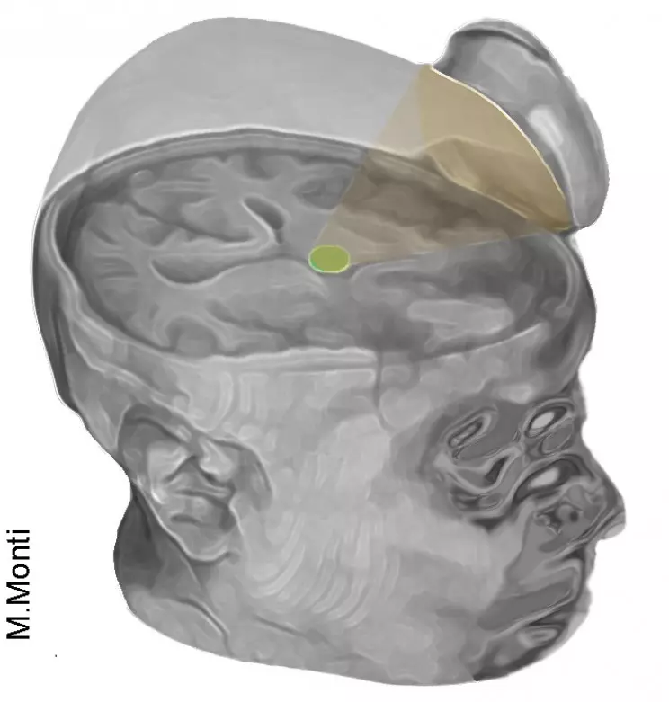 Úsáideann Eolaithe Ultrafhuaim chun Brains Dhá Chomatose Othair a Léim