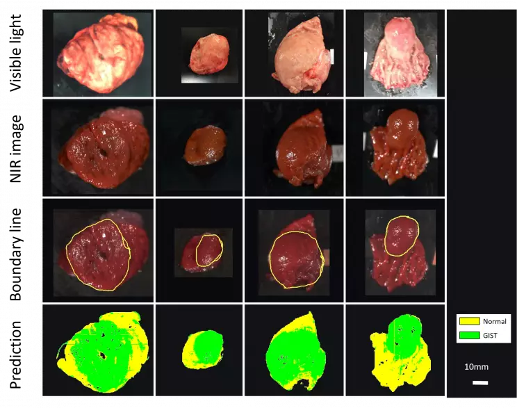 Tumors အရွယ်အစား MD