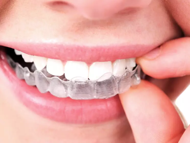 Dier zur Neier Orthodontik: Wien huet den Invisible Invisalign erfonnt?