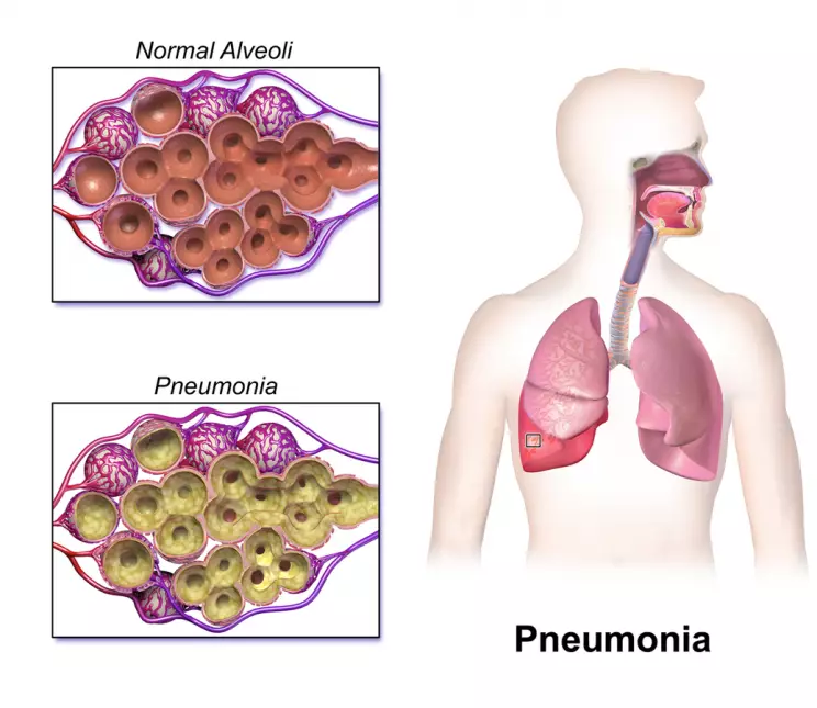 pneumonie