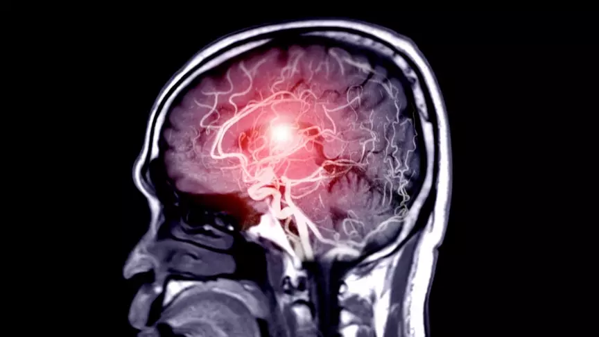 Các nhà khoa học đã sử dụng hình ảnh cộng hưởng từ để lần đầu tiên cho thấy tình trạng viêm não in vivo