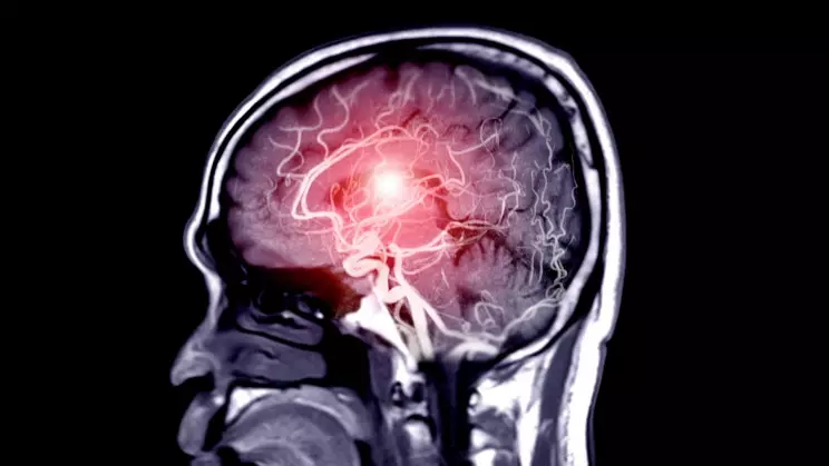 Para ilmuwan nggunakake pencitraan resonansi magnetik kanggo nuduhake inflamasi otak ing vivo kanggo pisanan