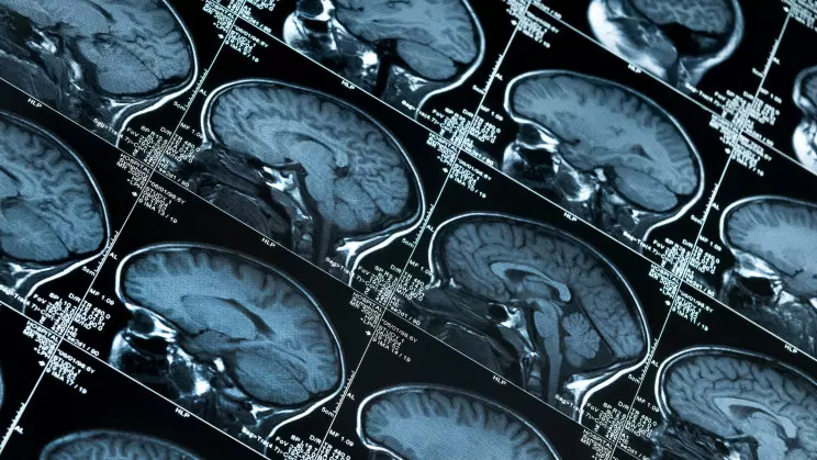 Teadlased astuvad veel ühe olulise sammu Alzheimeri tõve mõistatuse lahendamiseks