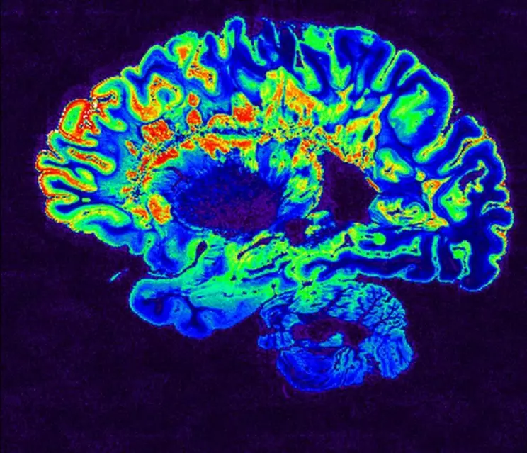 Narkoba Alergi Over-The-Counter Nyaéta Ngabalikeun Karusakan Dilakukeun ku Multiple Sclerosis