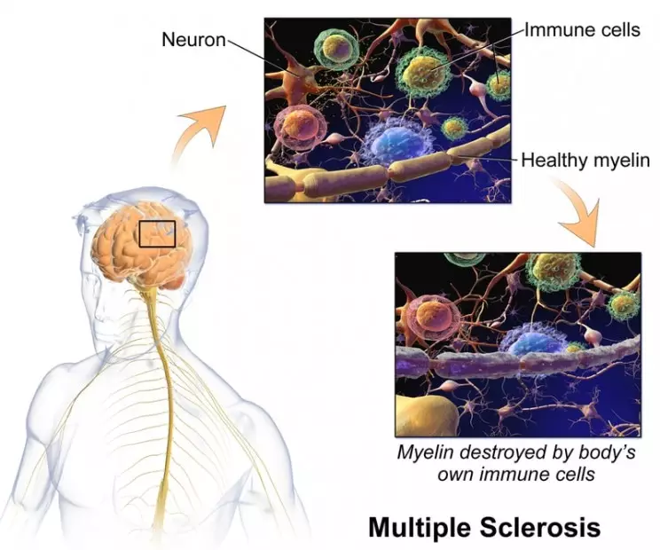 Narkoba Alergi Over-The-Counter Nyaéta Ngabalikeun Karusakan Dilakukeun ku Multiple Sclerosis