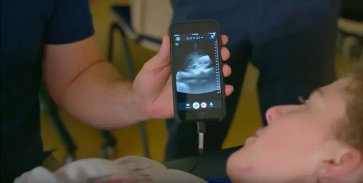 이 저렴한 iPhone 초음파 기계는 의사가 자신의 암을 발견하도록 도왔습니다.