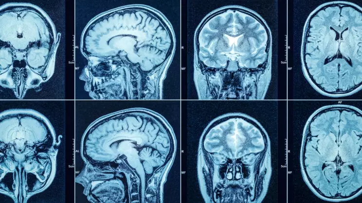 વૈજ્ઞાનિકો મગજના ચાર્ટ બનાવે છે જે દર્શાવે છે કે મગજ જીવનકાળ દરમિયાન કેવી રીતે બદલાય છે