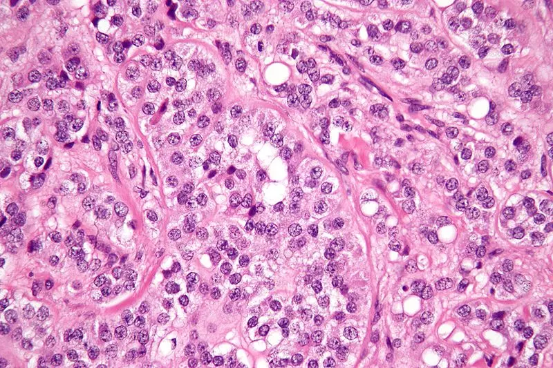 800px-Sertoli_cell_tumor_high_mag