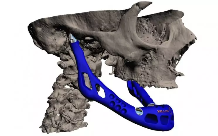 3D atspausdintas apatinis žandikaulis Xilloc