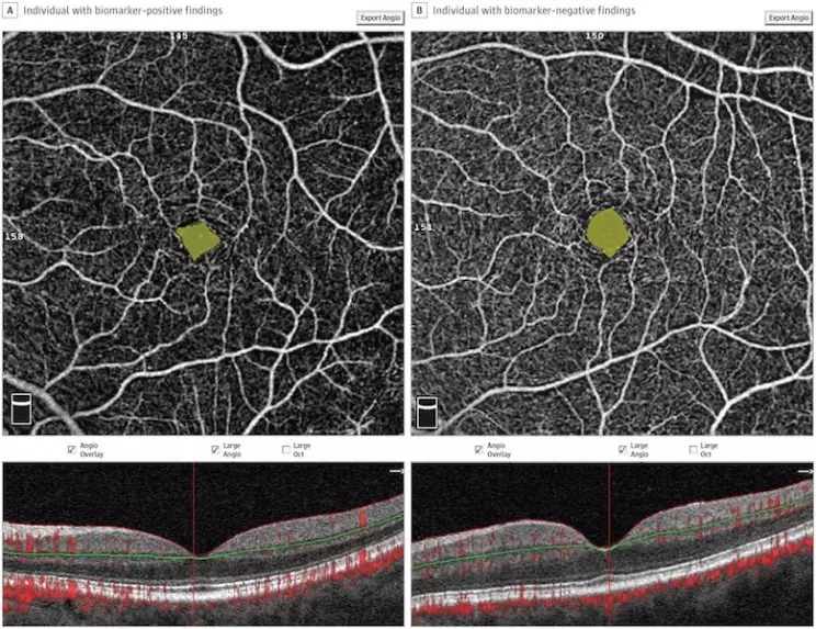 Il morbo di Alzheimer può essere previsto con un semplice esame della vista