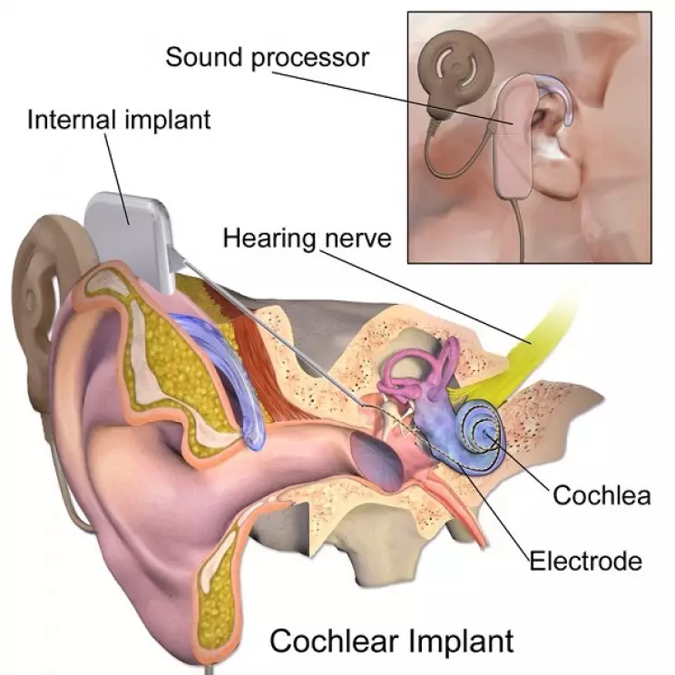 NASA spingoffs Cochlear implantlary