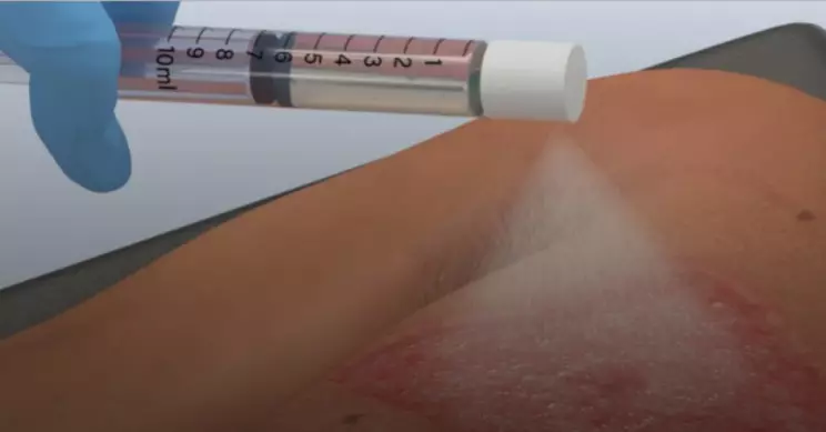 FDA stëmmt Éischt Spray-On Haut fir Burn Behandlung
