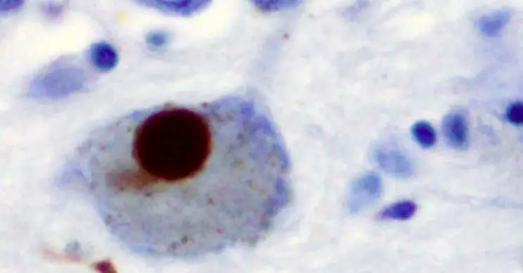 Bagong Molecule na Naka-link sa Paghinto at Pagbabalik sa Neuro Damage na Nagawa ng Parkinson's Disease