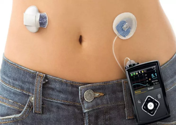 Wearables en nije technology foar diabetesbehanneling