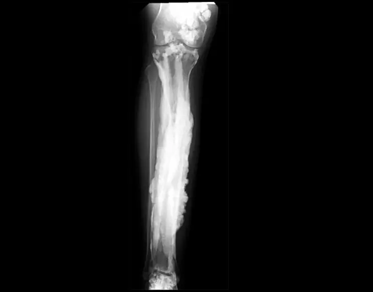 Talagsa nga mga sakit https://inteng-storage.s3.amazonaws.com/images/APRIL/melorheostosis-of-the-leg.jpg