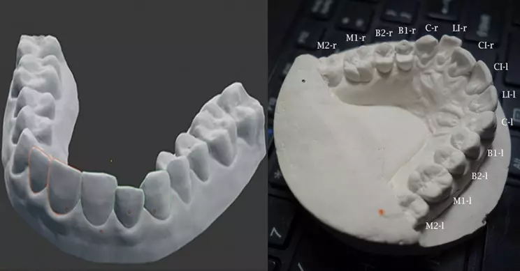 വളഞ്ഞ പല്ലുകൾ ശരിയാക്കാൻ കോളേജ് വിദ്യാർത്ഥി 3D പ്രിന്റുകൾ വിലകുറഞ്ഞ DIY റിറ്റൈനറുകൾ