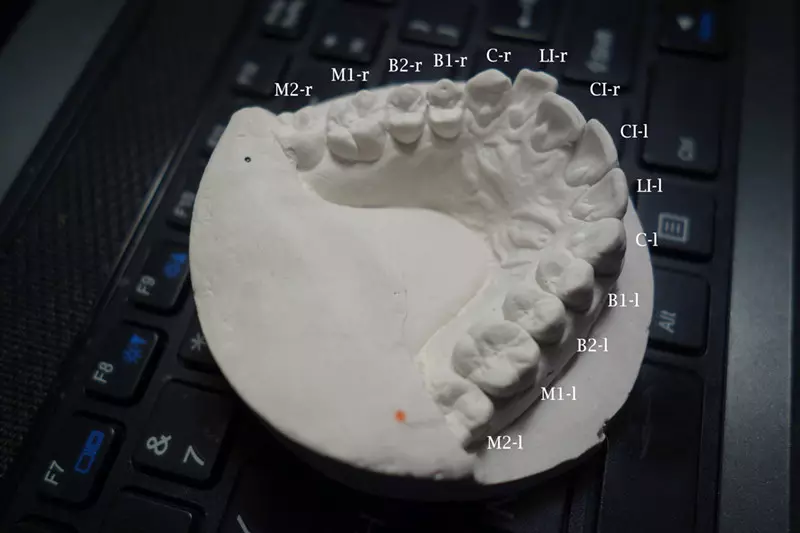 muffa dei denti che mostra un dente anteriore sovrapposto